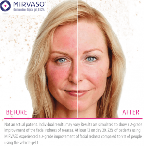 Get Real Redness Relief for Rosacea with MIRVASO